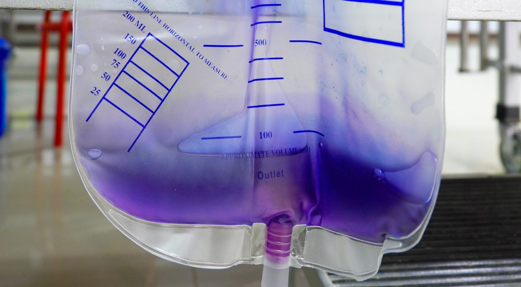 What Causes Purple Urine: Unveiling the Mysteries