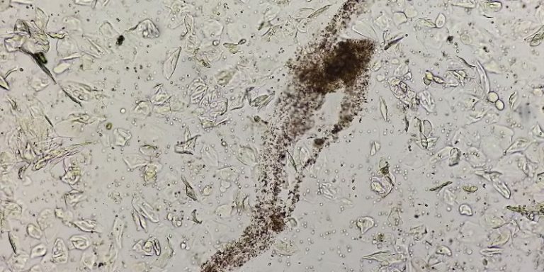 What Does Hyaline Casts in Urine Mean: A Comprehensive Guide