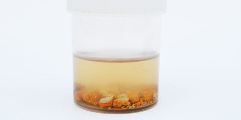 What Do Kidney Stones Look Like in the Toilet?